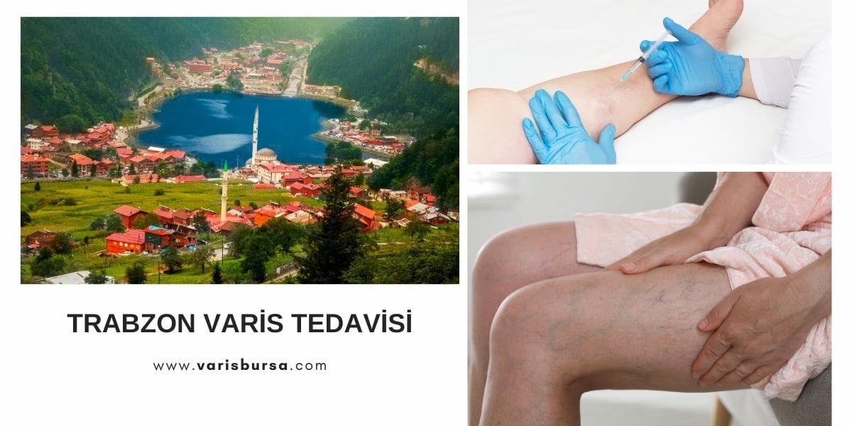 Trabzon Varis Tedavisi - Natural Klinik